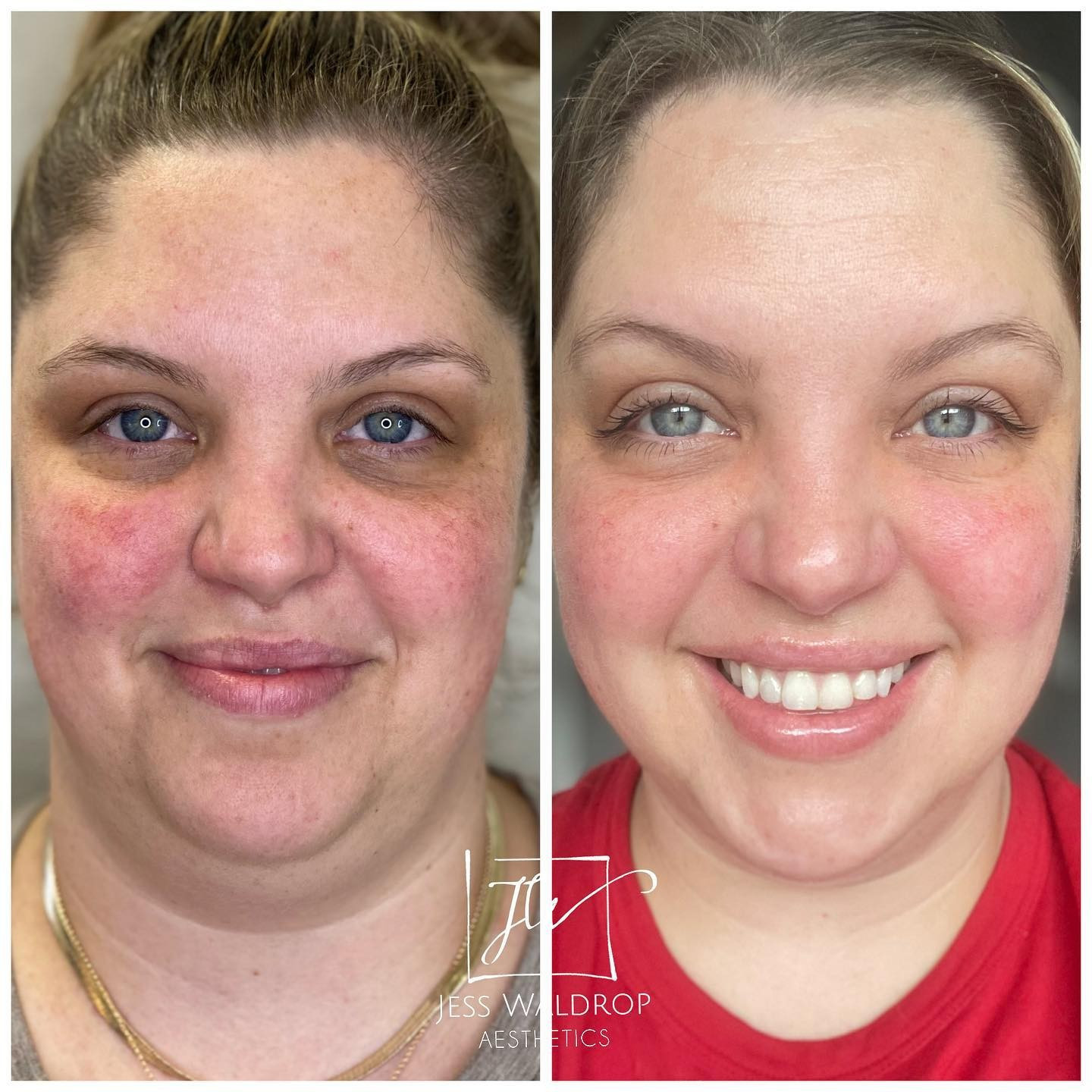 prx benefits and before and after