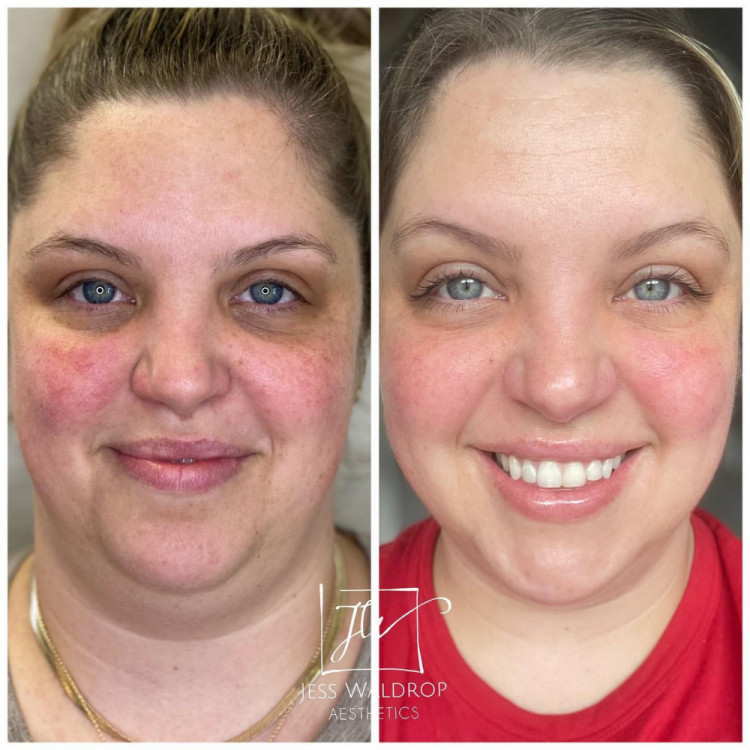 prx benefits and before and after