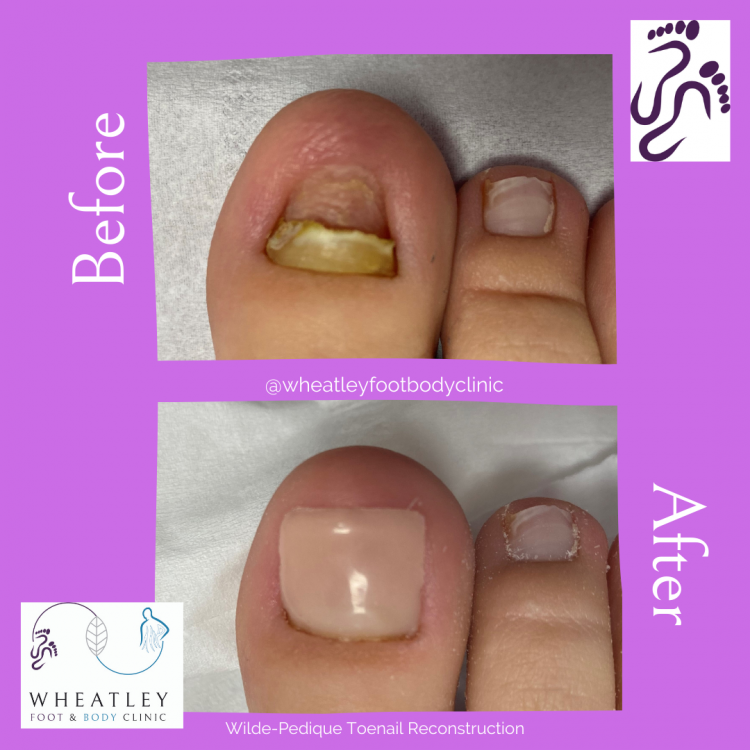 Toenail Reconstruction