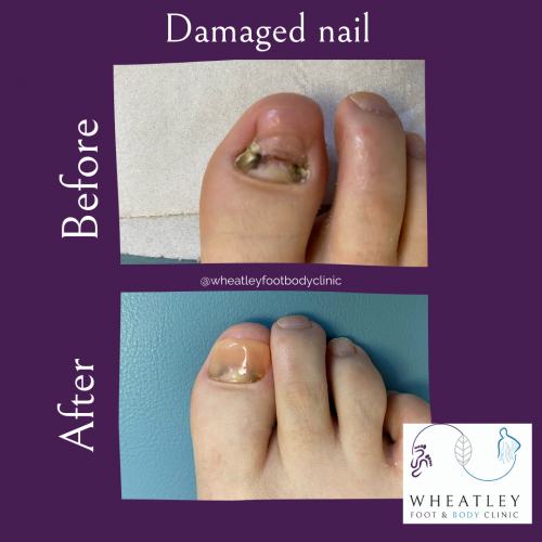 Toenail Reconstruction